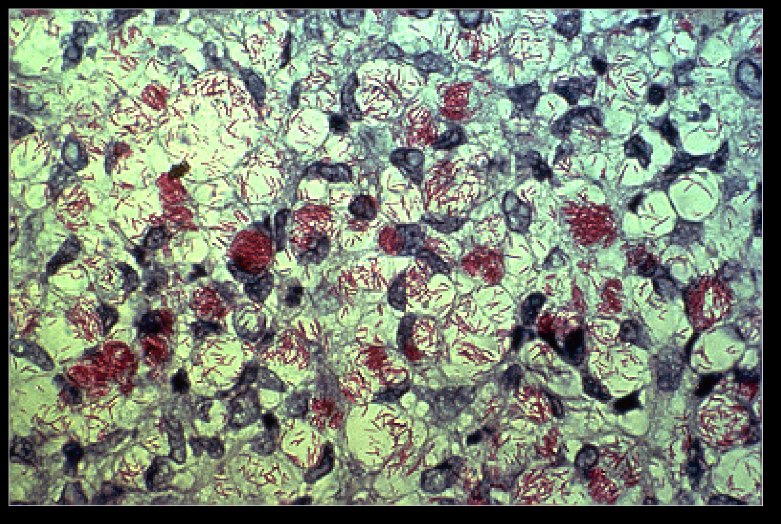 Lepra (guba) | Hrvatski zavod za javno zdravstvo